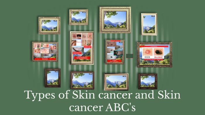 Types of Skin cancer and Skin cancer ABC's by Miranda Bretthauer on Prezi
