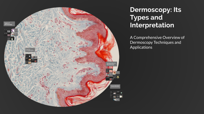 Dermoscopy: Its Types and Interpretation by Abdul Hadi Wafa on Prezi
