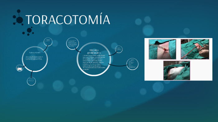 TORACOTOMÍA by Tatiana QuinTero on Prezi