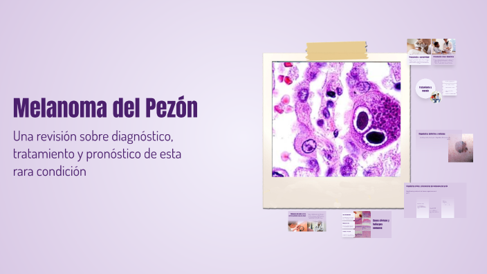 Melanoma del Pezón by Susana Jiménez on Prezi