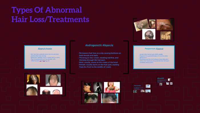 Types Of Abnormal Hair Loss/Treatments by Desiree Carrillo on Prezi
