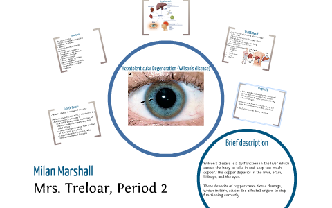 Wilson's disease presentation by Milan Marshall on Prezi