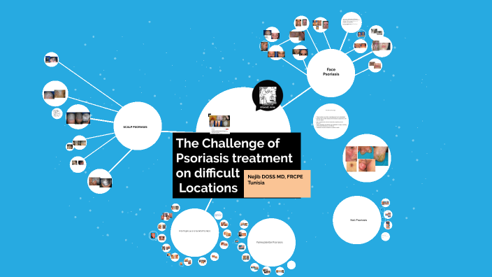 The Challenge of Psoriasis on Difficult Locations by Nejib DOSS on Prezi