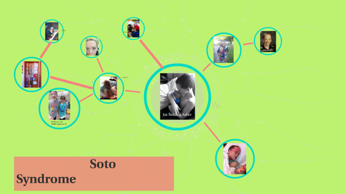 Soto Syndrome by Jordyn Bjerke on Prezi