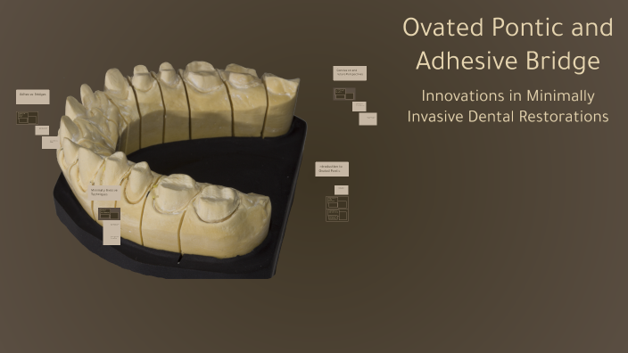 Ovated Pontic and Adhesive Bridge by Rama Suleiman on Prezi