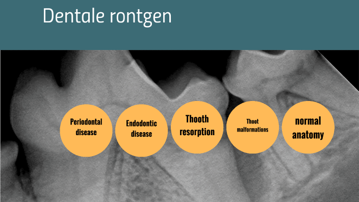 Dentale rontgen by Irene de heer on Prezi