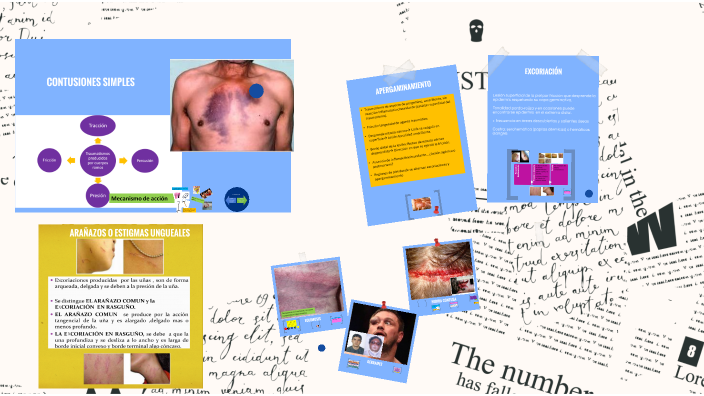 CONTUSIONES SIMPLES KEVIN CARAGULLA by Kevin Caragulla on Prezi