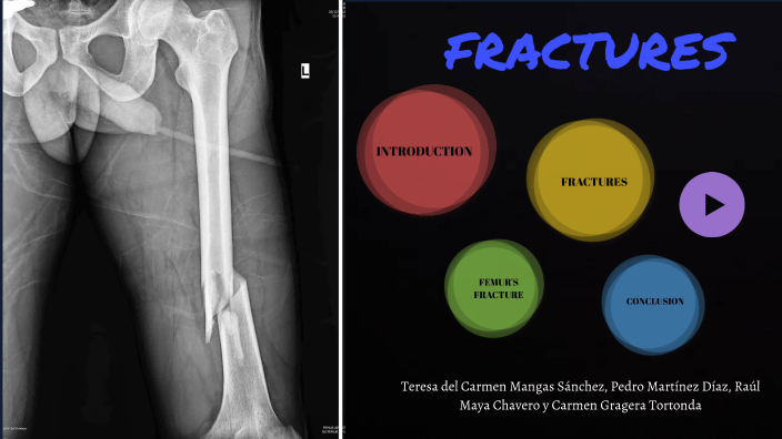 Fractures by Mart nez D az Pedro on Prezi