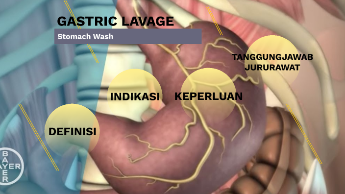 GASTRIC LAVAGE by Zatinurnadiah Abd Hakim on Prezi