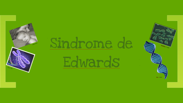 Sindrome de Edwards by Gianluca Martin on Prezi