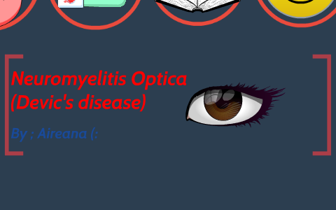 Neuromyelitis Optica (Devic's disease) by Aireana Michelle on Prezi