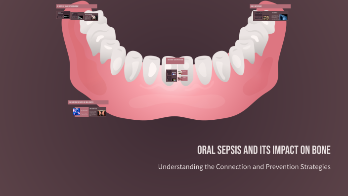 Oral Sepsis and Its Impact on Bone by soundarya biradar on Prezi
