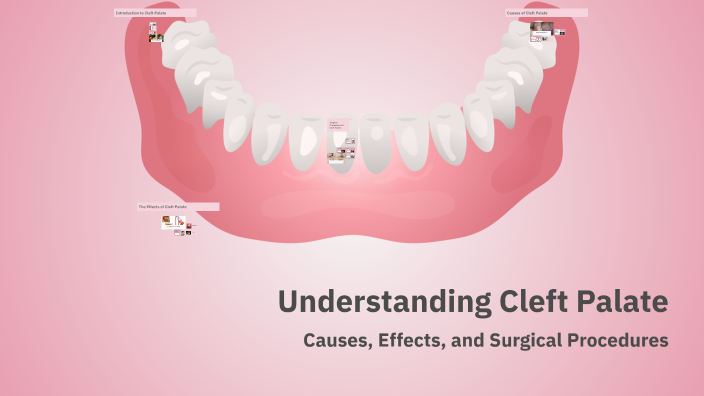 Understanding Cleft Palate by Devon Dominguez-Dipiazza on Prezi