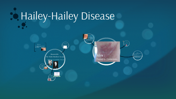 Hailey-Hailey Disease by Yesenia Vasquez on Prezi