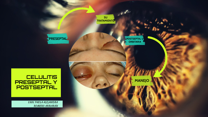 celulitis pre y postseptal by Paolita Romero Arriaran on Prezi