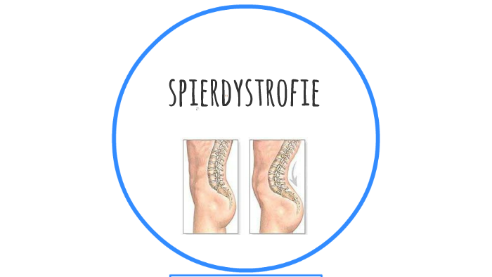 spierdystrofie by pixie moortgat on Prezi