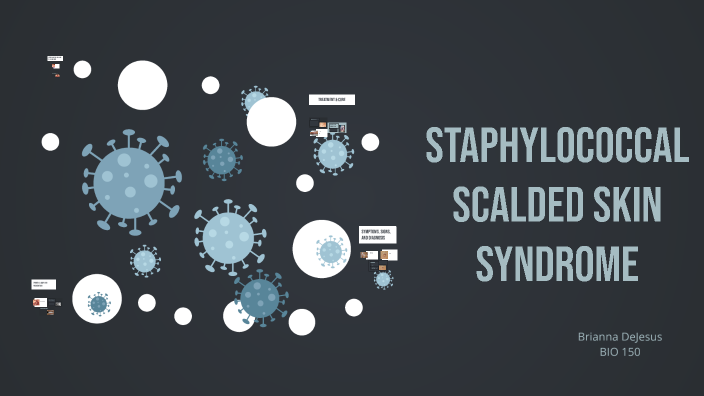 Staphylococcal Scalded Skin Syndrome by Brianna DeJesus on Prezi