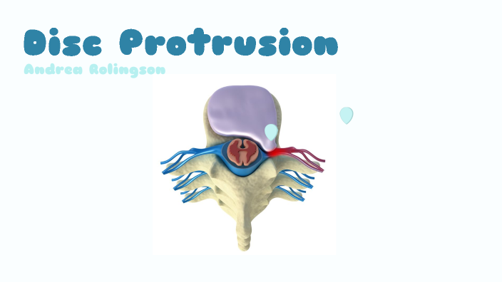 Protrusion by Andrea Rolingson on Prezi