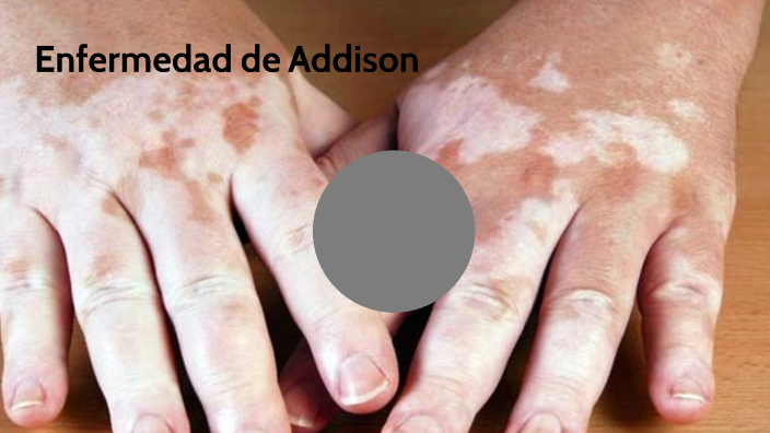 La enfermedad de Addison by Emmanuel david Guerrero brand on Prezi