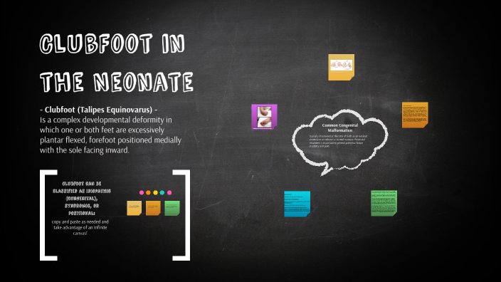 Club Foot in the Neonate by Audra Sherman on Prezi