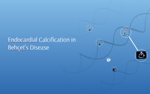 Endocardial Calcification in Behçet's Disease by Luisa Castillo Ley on ...