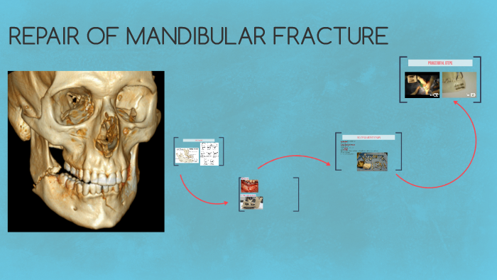 REPAIR OF MANDIBULAR FRACTURE by aryssa g on Prezi