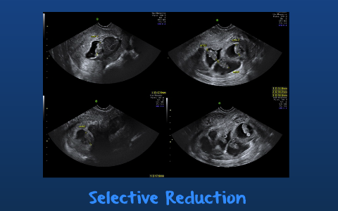 Selective Reduction by Alexis Skidmore on Prezi