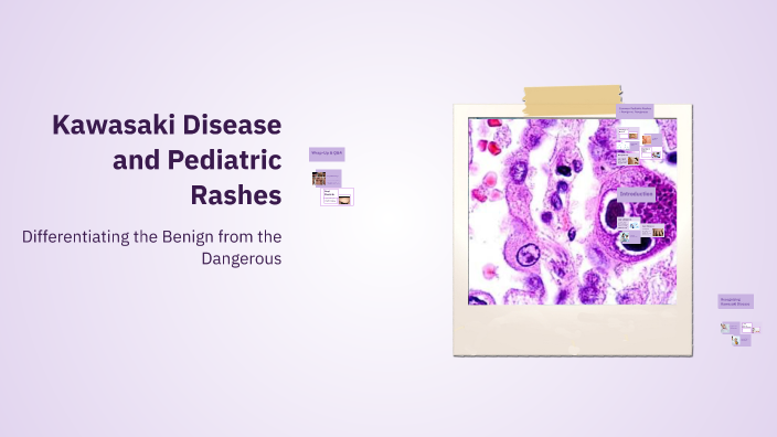 Kawasaki Disease and Pediatric Rashes by Kala Frye Bourque on Prezi