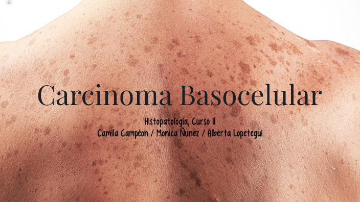 Carcinoma Basocelular by Camila Campeón on Prezi