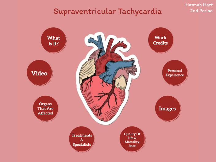 Science Project - Supraventricular Tachycardia by Hannah Hart on Prezi