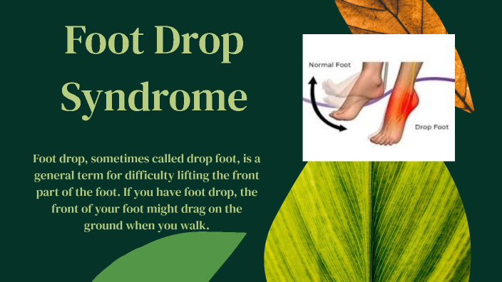 Foot Drop Syndrome by Chase Van Ranst on Prezi