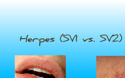 Herpes (SV1 vs. SV2) by Kylie Wyskochil on Prezi