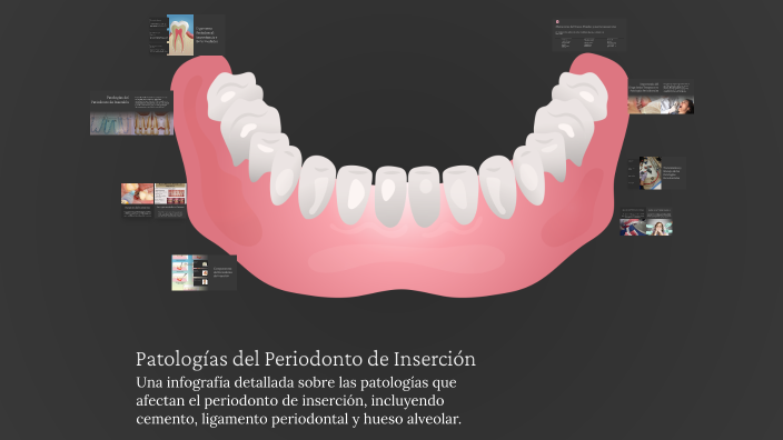 Patologías del Periodonto de Inserción by LIZETH CORDERO SAIRE on Prezi