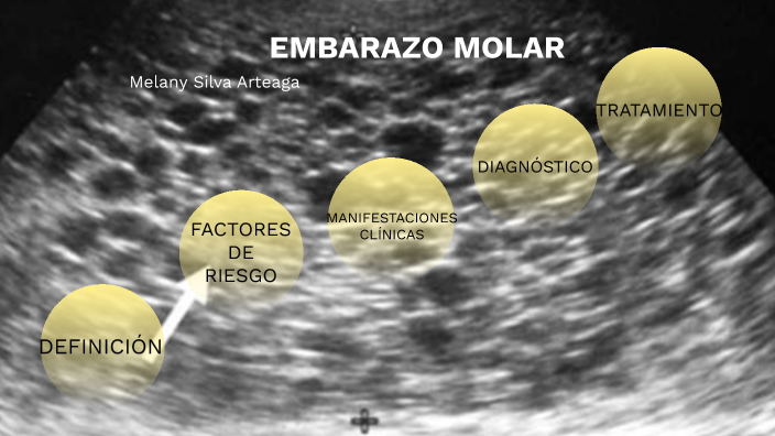 Embarazo Molar by Mel S on Prezi