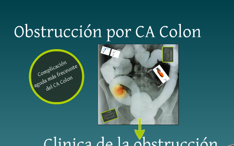 Obstrucción por cáncer de cólon by pablo villanueva