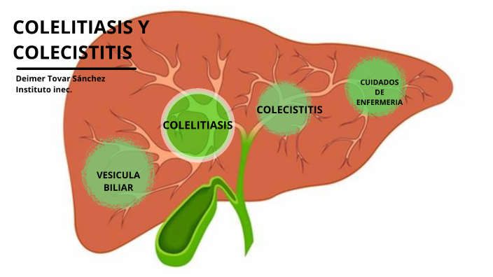 colelitiasis y colecistitis deimer tovar sanchez by DEIMER TOVAR on Prezi