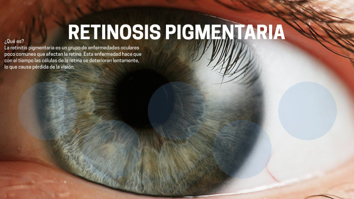 RETINOSIS PIGMENTARIA by Alicia Penuelas on Prezi