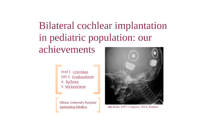 Bilateral cochlear implantation in pediatric population: our by on Prezi