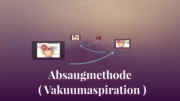 Absaugmethode ( Vakuumaspiration ) by Andrea Vogt on Prezi