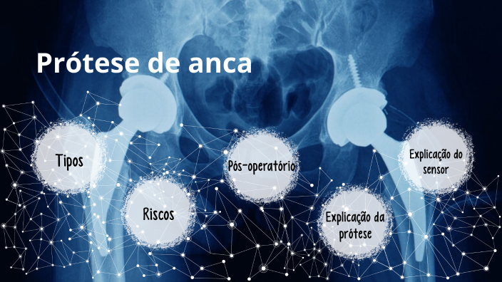 Prótese de anca by Ana Martins on Prezi