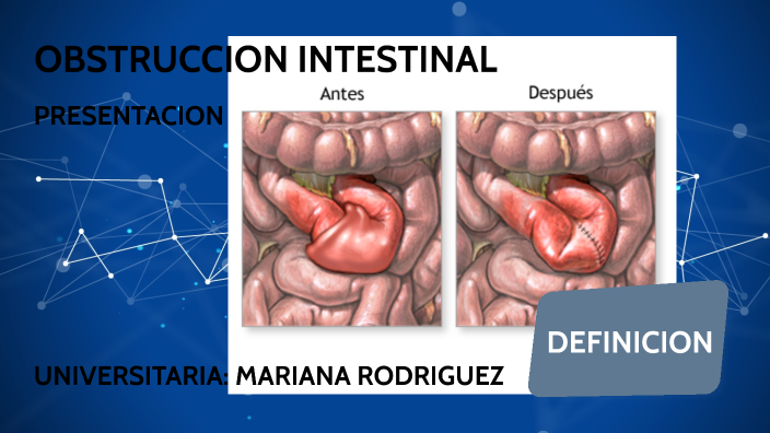OBSTRUCCION INTESTINAL by Mariana Rodriguez on Prezi