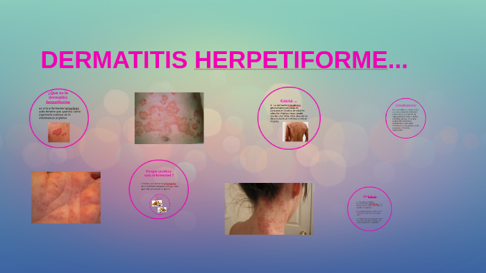 DERMATITIS HERPETIFORME... by feliza vasquez on Prezi