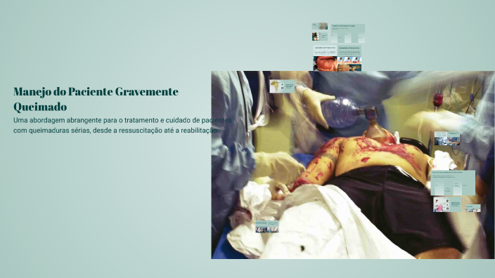 Manejo do Paciente Gravemente Queimado by LAIZA COLOMBO on Prezi
