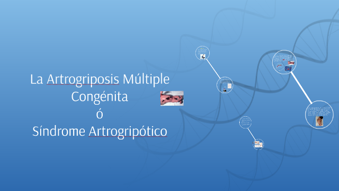La Artrogriposis Múltiple Congénita by juliana rocha