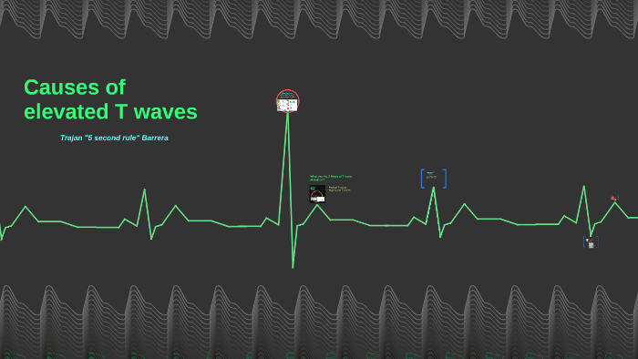 Causes of T wave elevation by Trajan Barrera on Prezi