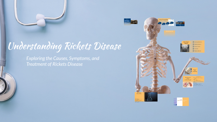 Understanding Rickets Disease by Juliza Karmolinski on Prezi