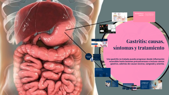 Understanding Gastritis: Causes, Symptoms, and Treatments by DAPHNE ...
