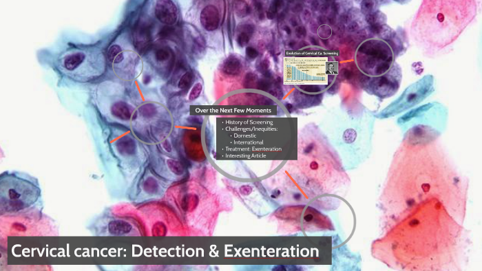 Evolution of Cervical Ca. Screening by Caleb Pearce on Prezi