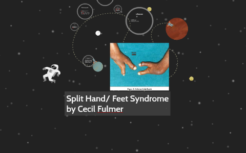 Split Hand Syndrome by Cecil Fulmer on Prezi