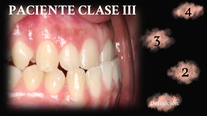 PACIENTE CLASE III by Abel Noe Olea Galvez on Prezi